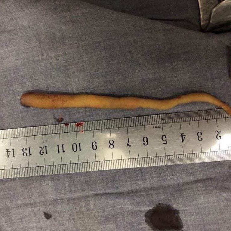 DID YOU KNOW some people were born with TAILS? (Photos) - Nigerian ...