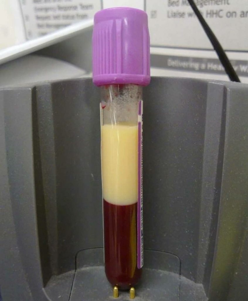 See why you need to go for a Lipid profile test (cholesterol test ...
