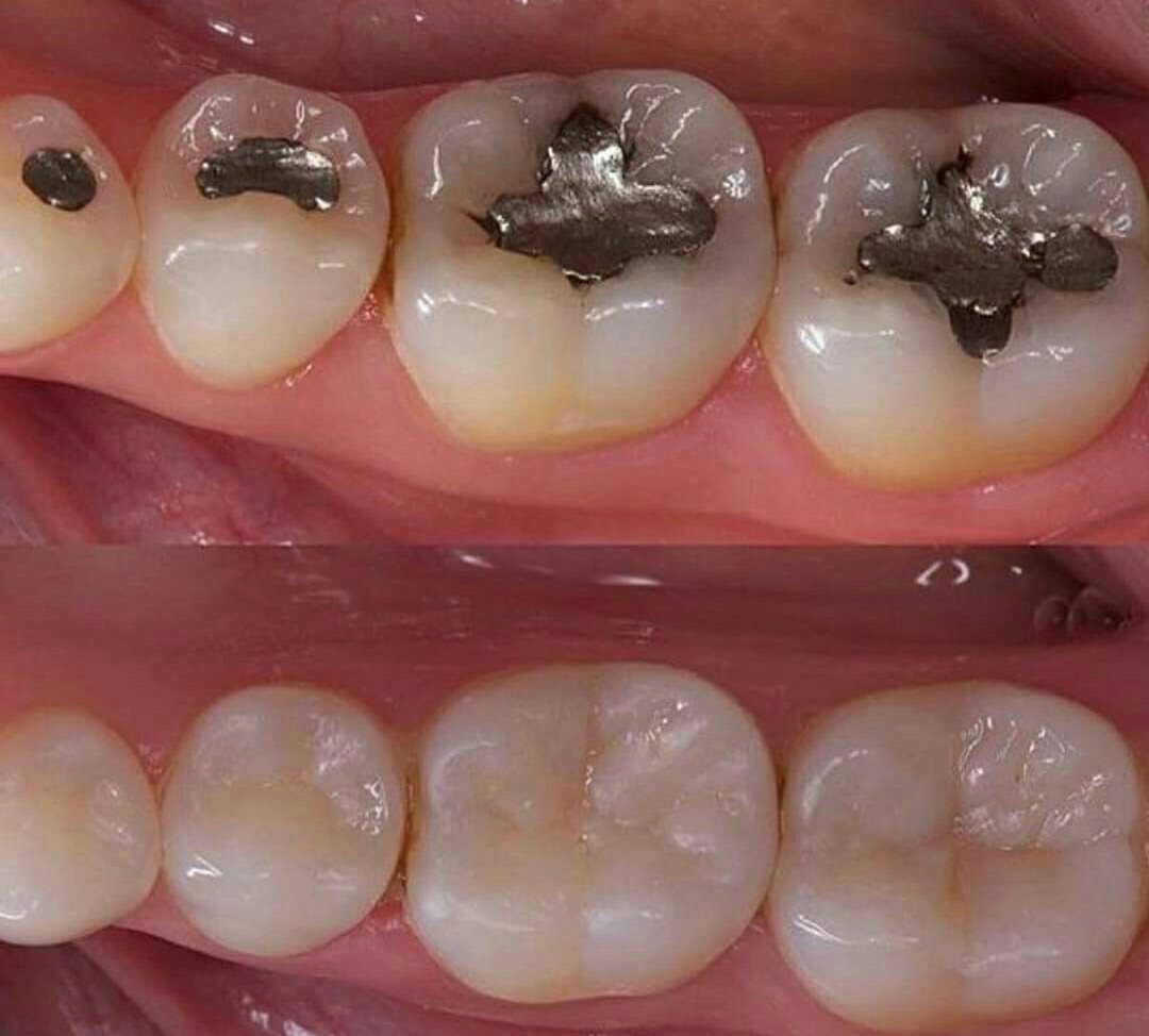 How Much Does Tooth Filling Cost In Nigeria Procedures Nigerian
