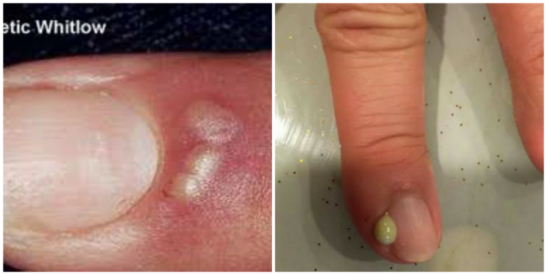 Whitlow Vs Paronychia: The difference between Whitlow and Paronychia ...