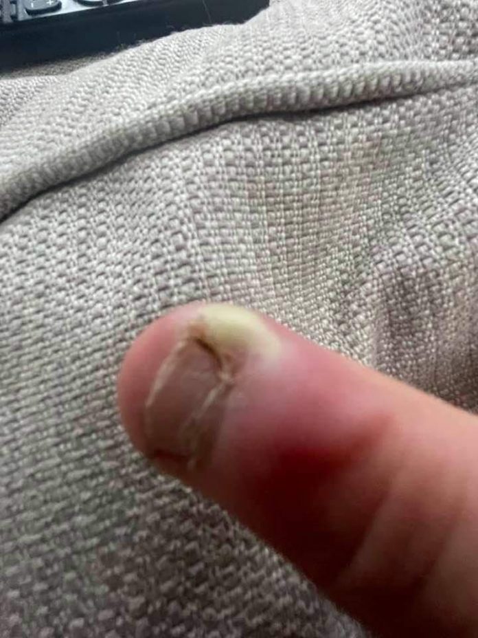 How to treat whitlow at home: Local remedy for whitlow - Nigerian ...