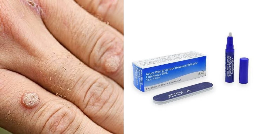 How to use silver nitrate sticks for warts - Nigerian Health Blog