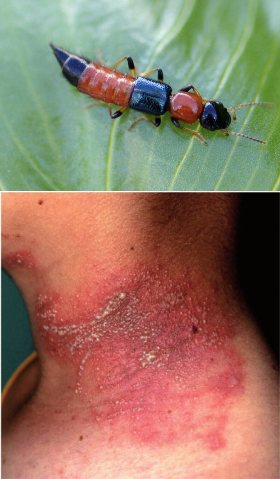 Skirt and Blouse Insect bite (Rove Bettles) - Nigerian Health Blog